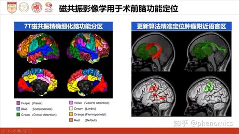 Phenomics表型组学前沿论坛第五十六期脑胶质瘤可视化与精准治疗圆满举办 知乎