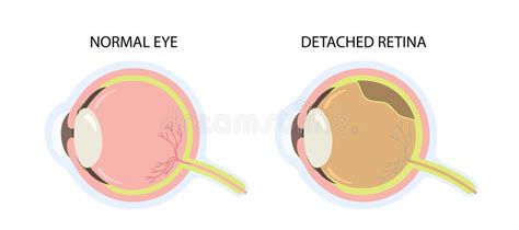Cross Section Retinal Detachment Eye Vector Illustration Stock Vector Illustration Of White