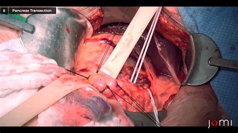 Open Distal Pancreatectomy For Pancreatic Cancer Jomi