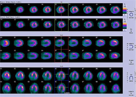 Lexiscan Stress Myocardial Perfusion Imaging Mpi Is Clinically And Download Scientific