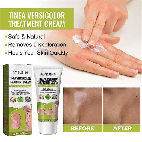 Tinea Versicolor Treatment Cream Body Antifungal Gel For Tinea