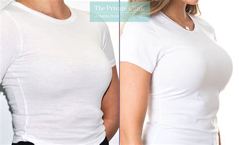 Tatler Top Breast Enlargement Surgeon London 2023 Best Breast