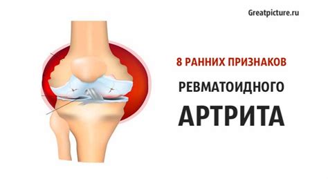 8 ранних признаков ревматоидного артрита о которых вы должны знать