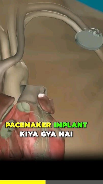Is It Safe To Have Sex After Pacemaker Implementation 🫀 Shorts Youtube