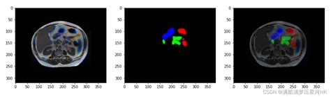 【kaggle：uw madison gi tract image segmentation】肠胃分割比赛：赛后复盘 数据再理解 csdn博客