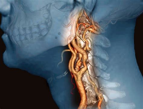 Atherosclerosis In Neck Arteries 3d Ct Bild Kaufen 12503800