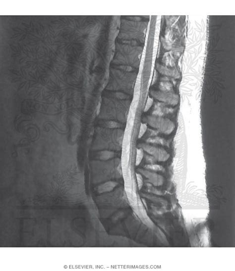 Midsagittal T2 Weighted MR Scan Of Lumbar Spine