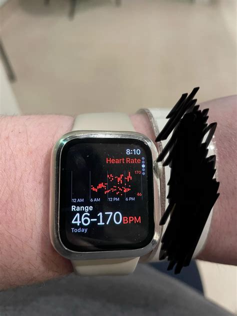 High Heart Rate Alert Found Atrial Flutter R Applewatch