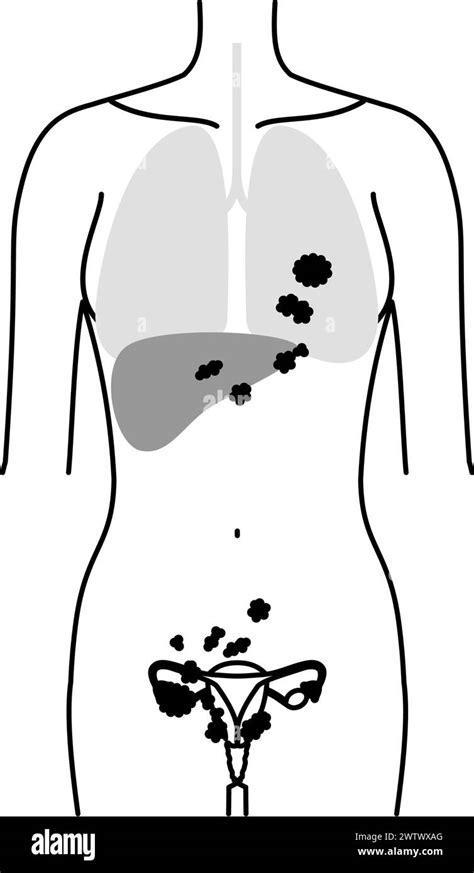 Illustration Schématique Du Cancer De Lovaire Stade Iv Anatomie De L