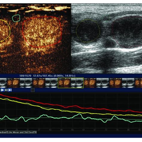 Quantitative Ceus Findings In Cervical Lymphoma And Cancerous Lymph