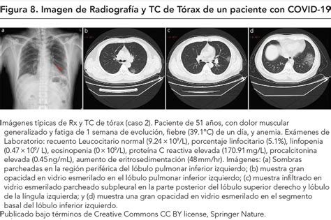 Corte heno cama informe radiografia torax normal Aplicando Estación de policía Instalación
