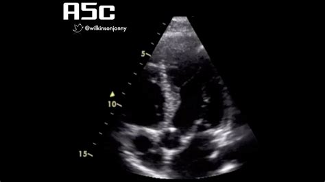 Apical 5 Chamber View A5c Youtube
