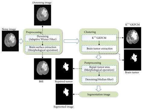 Brain Tumor Segmentation Based On Hybrid Clustering And Morphological Operations Pmc
