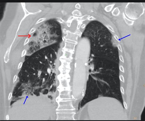 Pulmonary Embolism Chest X Ray