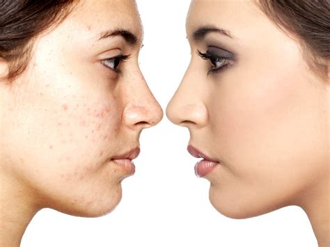 5 Best Ways To Remove Blemishes Naturally