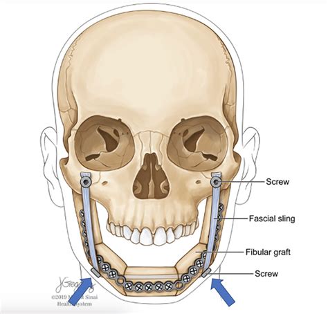 A Novel Technique To Prevent Or Correct Open Mouth Deformity After