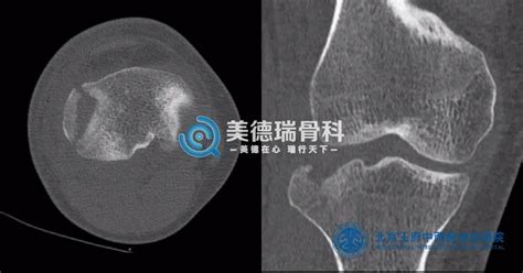 北京王府医院美德瑞骨科中心成功实施胫骨平台骨折切开复位手术，再显创伤手术专业优势 北京美德瑞骨科医生集团官方网站