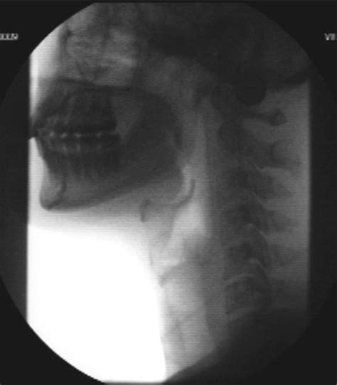 Dysphagia Vfss Diagram Diagram Quizlet