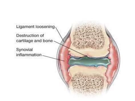 Rheumatoid Arthritis Ppt