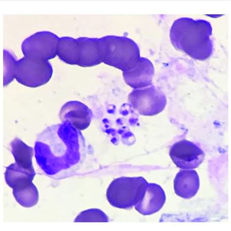 Bone Marrow Aspirate Smear From Bone Marrow Biopsy Stained With