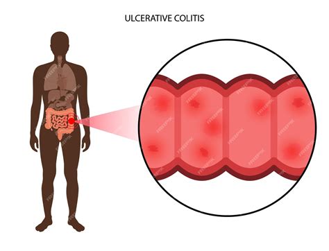 Premium Vector Intestine Ulcerative Colitis