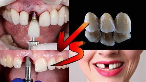 How To Replace A Missing Tooth Best Option Youtube
