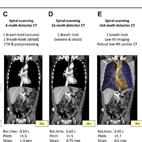 A G Graphical Representation Of The Evolution Of Third Generation Ct Download Scientific