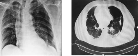 Patients Chest X‐ray And Chest Ct Scan Consisting Of Large Left‐sided