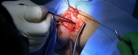 Posterior Sagittal Anorectoplasty Psarp For Imperforate Anus