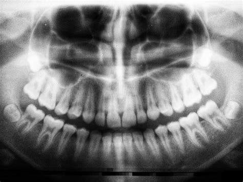 Signs Your Wisdom Teeth Are Coming In Dentistry On Coolum