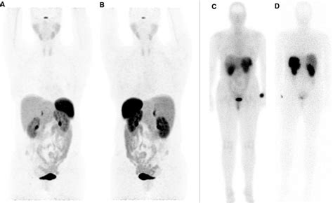 A 45 Year Old Woman With Carcinoid Tumor Of The Appendix Status Post Download Scientific