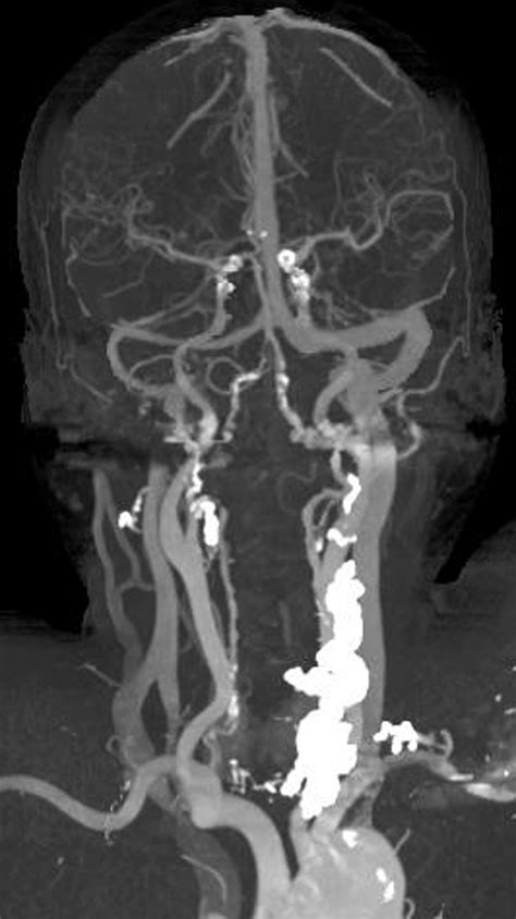 Coarse Calcification Is Seen Anterior To The Left Common Carotid Artery