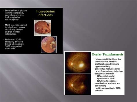 Infectious Uveitis Pptx Eye And Vision Conditions Diseases And