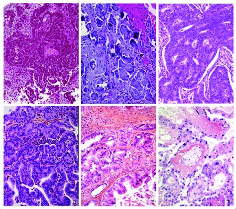 Ovarian Tumor Histiology