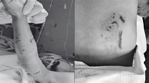 Perro pitbull ataca a niña en Trujillo y la deja con graves heridas Can sería sacrificado