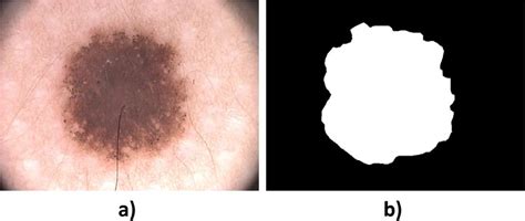 Skin Lesion Segmentation A Dermoscopic Image In Input B Binary