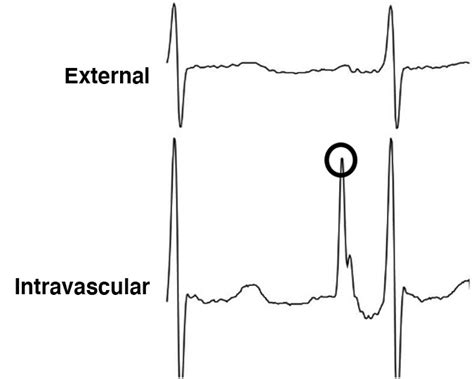 Appropriateness Of Replacing Fluoroscopic Guidance With Ecg