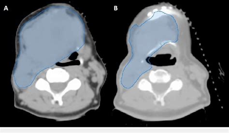 Computed Tomography Ct Simulation Images A Ct Simulation Performed