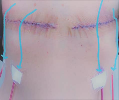 Cording A Side Effect Of Mastectomy MOBIEG