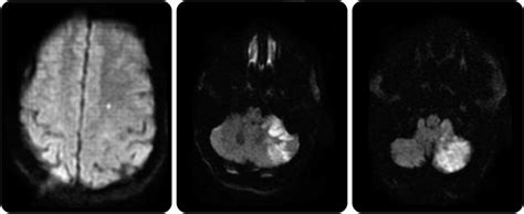 Mri Diffusion Weighted Sequence Download Scientific Diagram