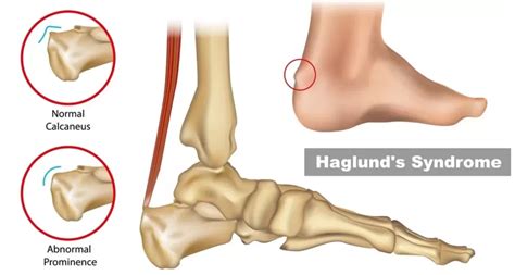 What Is Haglunds Deformity Treatment And Exercises