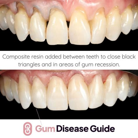 Bonding Vs Gum Grafting