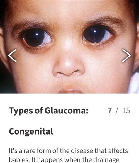 Congenital Glaucoma Symptoms In Babies Dionna Neill