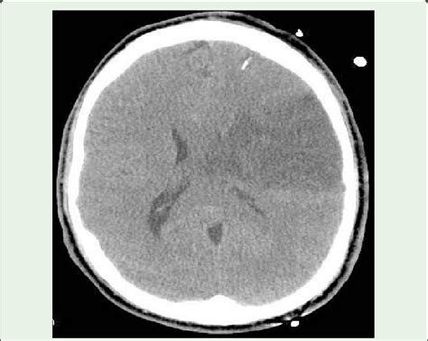 Axial Non Contrast Ct Image 5 Mm Showing A Left Located Mca Infarct