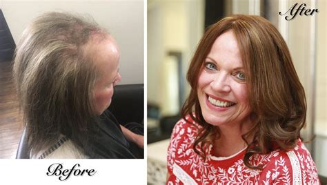 Best Hairstyles For Frontal Fibrosing Alopecia