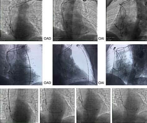 Panel A Y B Fluoroscopia Biplanar En Posición Anteroposterior Ap