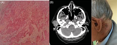 A Moderately Differentiated Squamous Cell Carcinoma Composed Of