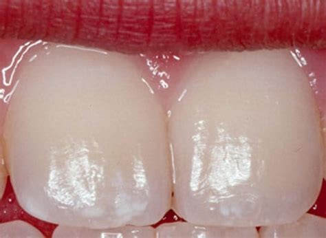 Fluorosis Exposure Prevention Management And Treatments