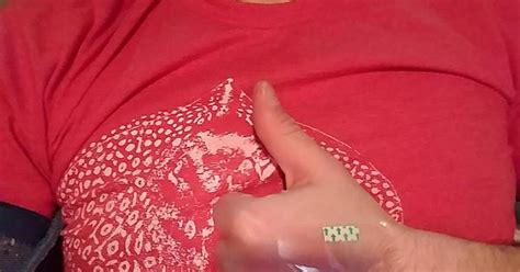 First Remicade Infusion Album On Imgur