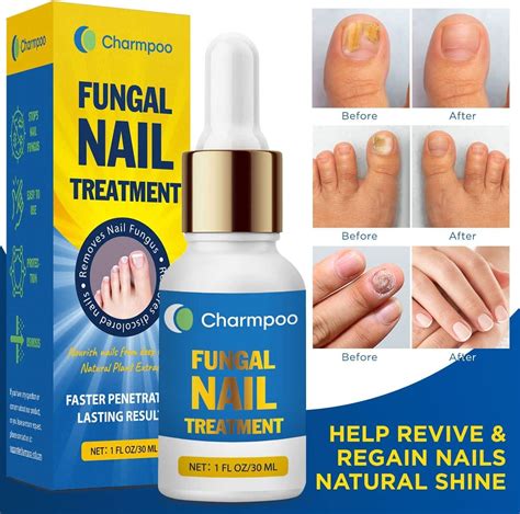 Fungal Nail Treatment Natural Antifungal Solution For Toe Fungus